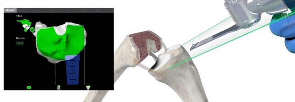 Knie-Endoprothetik Operationen mit dem Stryker Mako-Roboter | MVZ ...